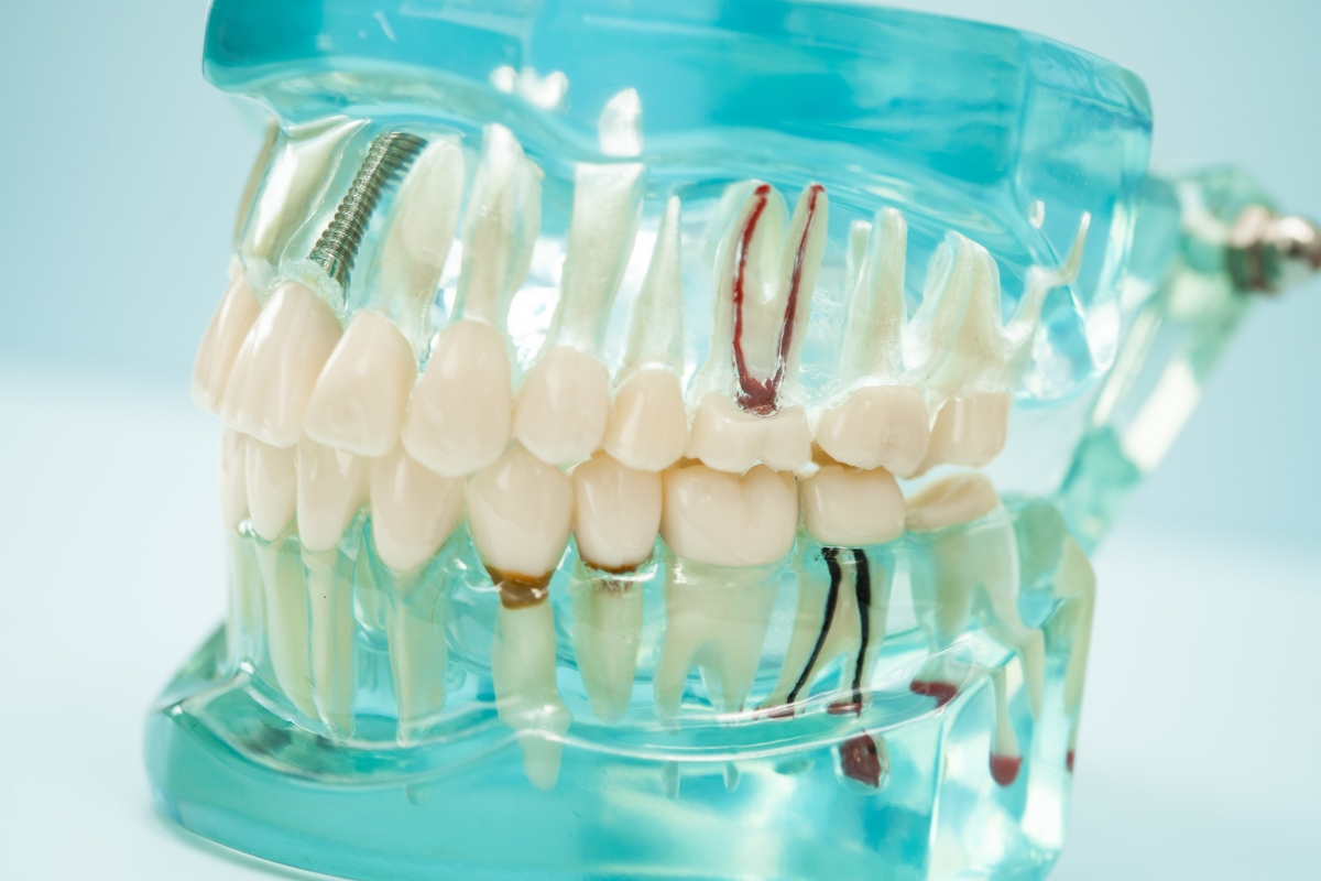 Root Canal vs. Implants: Save Your Healthy Tooth?